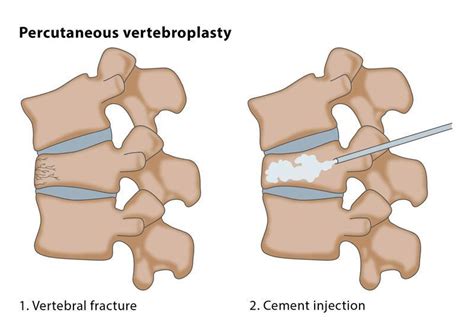 Compression Fracture Diagram