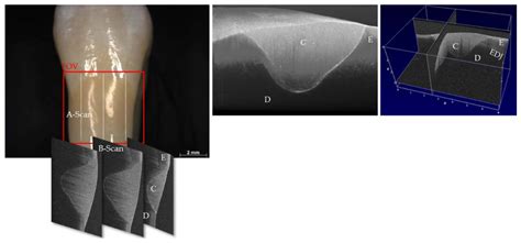 Optical Coherence Tomography Dental At Terri Trevino Blog