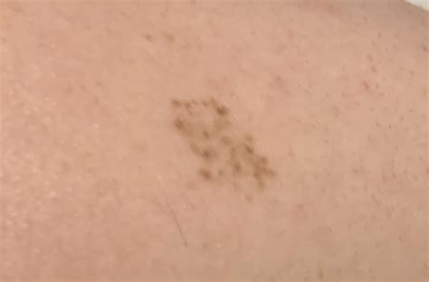 Strange Like Mole Or Lesion On Scalp Looks Like Brains Or Clusters