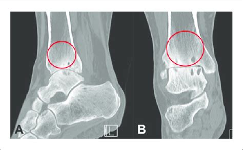 Measurement Of The Distal Tibia Curvature A Anteroposterior Sagittal Download Scientific