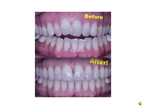 Occlusion And Its Types And Malocclusion Pptx