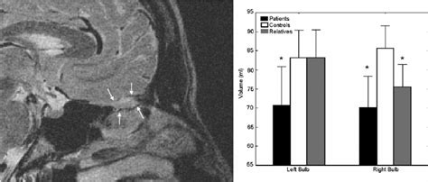 Left High Resolution Sagittal Mri Scan Of The Olfactory Bulb Arrows