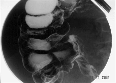 Double Contrast Barium Enema Showing Outlines Of The Inverted Appendix Download Scientific