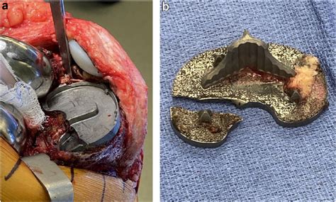 Clinical Observation During Revision Surgery Showing A Coronal