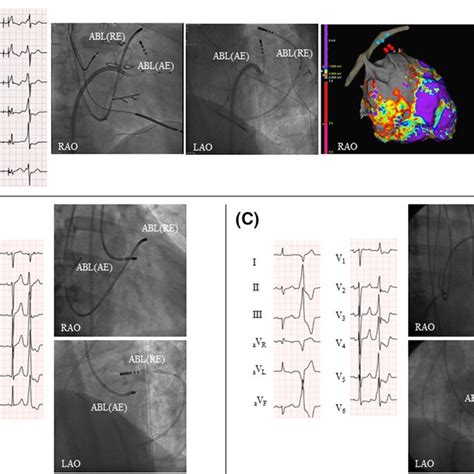 12‐lead Electrocardiograms Ecgs And Fluoroscopic Views For The 3 Download Scientific Diagram