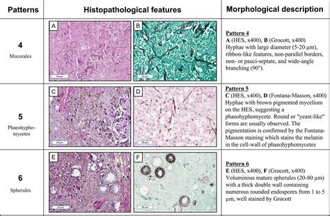 Fungal Integrated Histomolecular Diagnosis Using Targeted Next