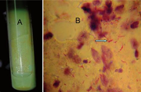 Clinical Manifestations Several Deep Erythemas Reddish Nodules On His Download Scientific