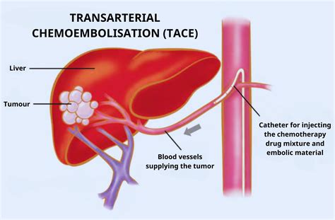 Liver Cancer Treatment With Transarterial Chemoembolisation Tace For