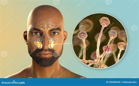 Aspergillus Fungi As A Cause Of Sinusitis Stock Illustration