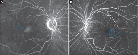 Angiogenesis The Good The Bad And The Ugly