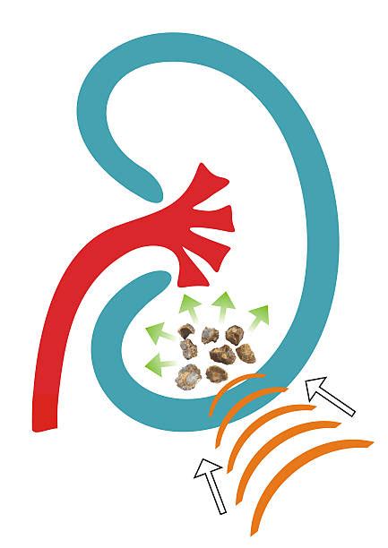 280개 이상의 신부전 일러스트 스톡 사진 그림 및 Royalty Free 이미지 Istock