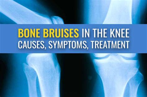 Bone Bruising In The Knee Causes Symptoms And Treatment