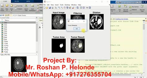 Brain Tumor Detection And Classification Using Image Processing Matlab