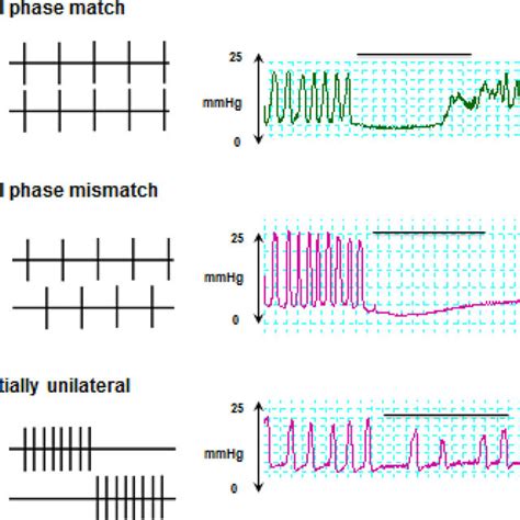 Effects Of Spinal Nerve Stimulation Bilateral Phase Match Stimulation