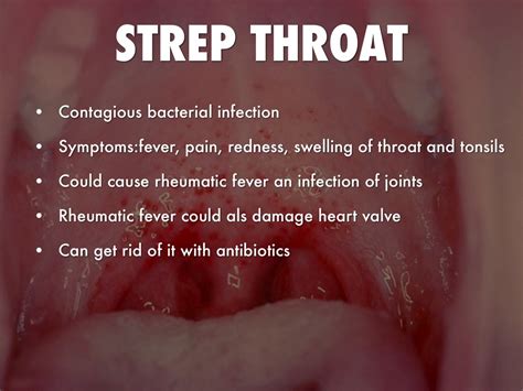 Strep Throat Contagious Nz