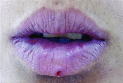 Diffuse Erythema Desquamation Fissures And White Pink Areas On The