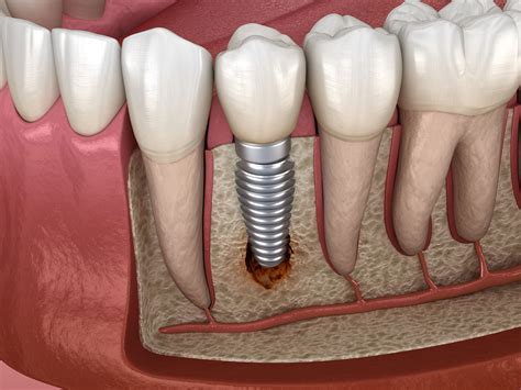 Dental Implants Procedure Problems