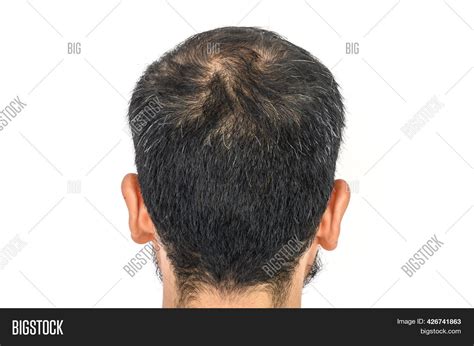Head Back Of Head At Victor Bartlett Blog