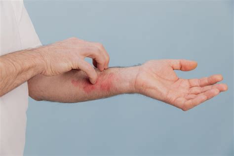 Bee Sting Treatment Symptoms And Causes Exposed