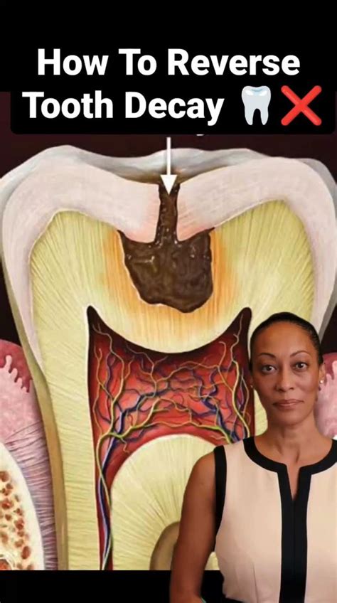Did You Know You Can Reverse Tooth Decay Video Reverse Tooth Decay