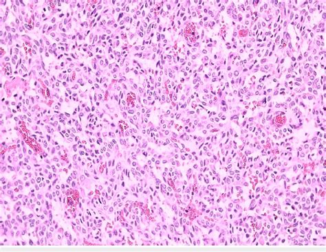 Shows Round Nuclei With Finely Stippled To Coarsely Clumped Chromatin