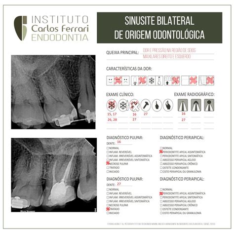 Sinusite Odontogênica Bilateral