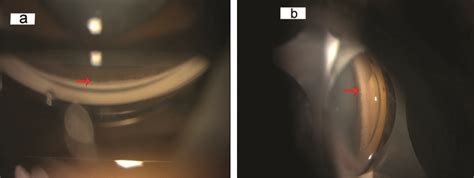 Posterior Embryotoxon Gonioscopy