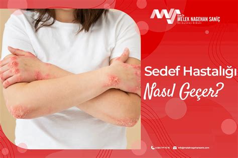 Sedef Hastalığı Nedir Nagehan Saniç