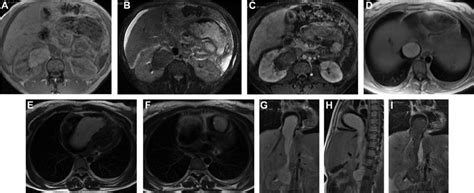 Mri Axial T1 Gre A Axial T2 Turbo Spin Echo With Fat Saturation Download Scientific