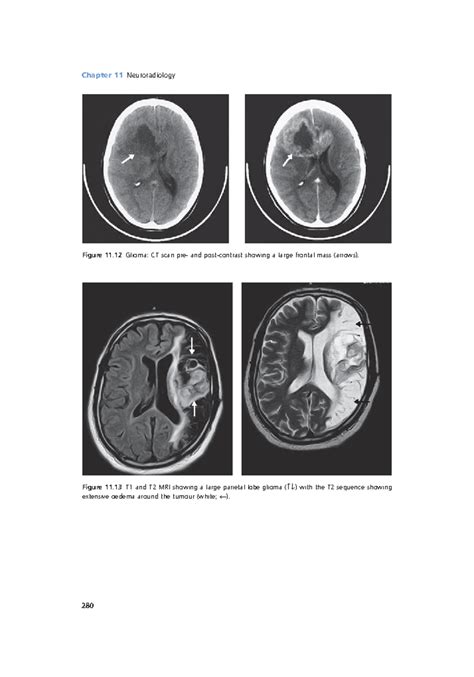 Radiology Lecture Notes Pdf 94 Chapter 11 Neuroradiology 280 Figure 11 Glioma Ct Scan Pre