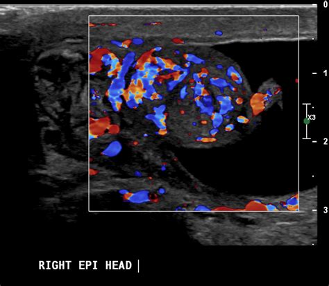 Epididymo Orchitis Radiology Case
