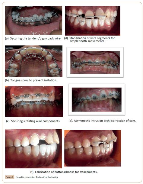 Flowable Composite Add On In Orthodontics Insight Medical Publishing Flowable Composite Add On In Orthodontics Insight Medical Publishing