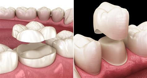 Onlays Vs Crowns Making The Best Choice For Your Dental Health In