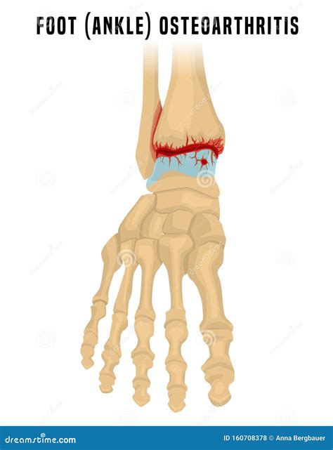 Osteoarthritis Of The Hip Joint And Hip Replacement Surgery Medical