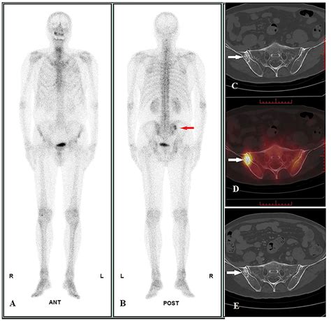 Frontiers The Diagnostic Value Of Quantitative Bone Spectct In Solitary Undetermined Bone Lesions