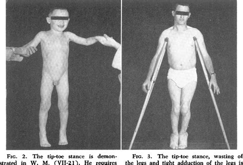 Figure 2 From A Sex Linked Recessive Form Of Spastic Paraplegia