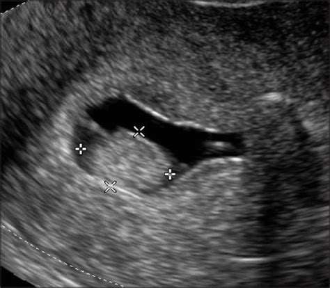 Saline Infusion Sonohysterography Versus Hysteroscopy For Uterine