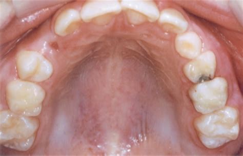 Preclinical Mixed Dentition And Occlusion Flashcards Quizlet