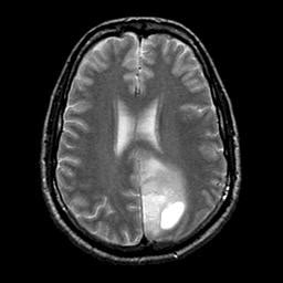 Brain And Tumor Extraction A Sample Image B Brain Extraction Using Download Scientific