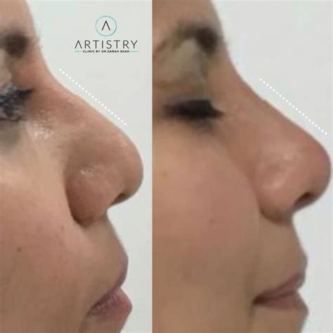 Snub Nose Symptoms Causes And Treatments