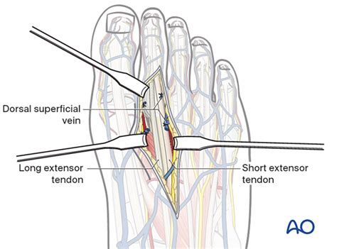 Dorsal Approach To Single Metatarsals 2 4