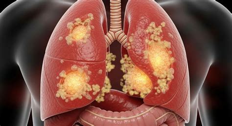 Pneumonia Symptoms Treatments And Prevention