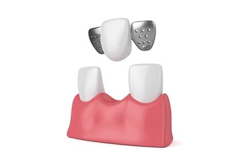 Impacted Tooth Tooth Impaction Causes Signs And Symptoms Treatment