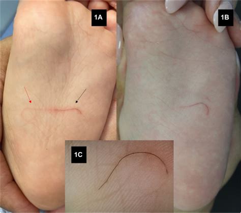 A Creeping Eruption Jaad Case Reports