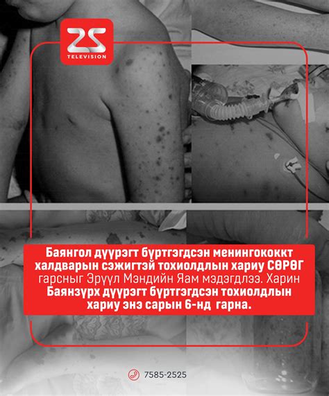 25ЦАГ МЭДЭЭ 🔴Баянгол дүүрэгт бүртгэгдсэн менингит халдварын сэжигтэй тохиолдлын хариу СӨРӨГ