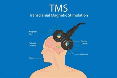 What Is The Difference Between ECT And TMS Dr Marcelle Stastny