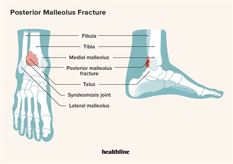 Medial Malleolus Fracture