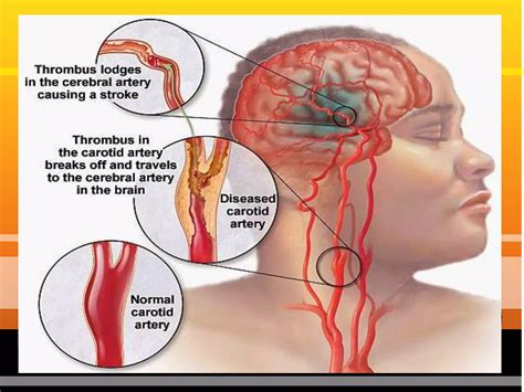Ppt Stroke1 Pptx