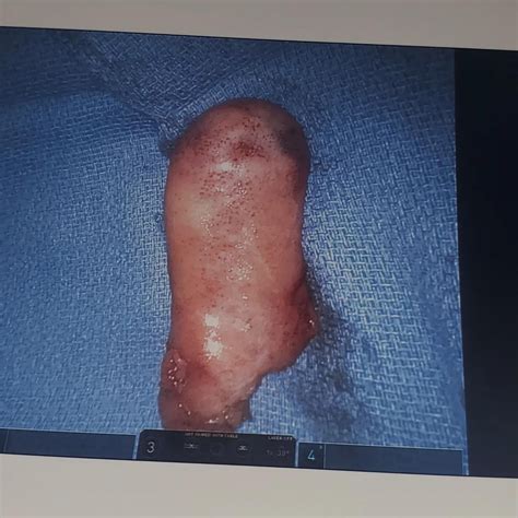 19yo Male My Gallbladder Removal Was Told By My Surgeon Who Removed