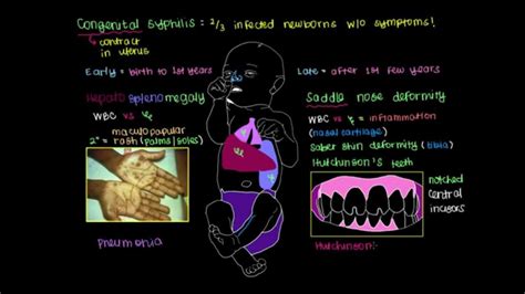 Congenital Syphilis Diagram Typical Features Of Congenital Syphilis